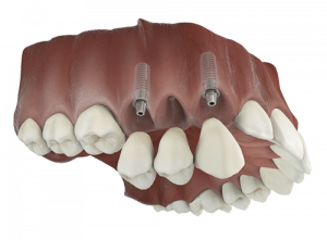 Straumann Dental Implants | Dental Care Centre