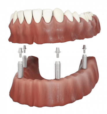 Silver crown tooth - Strengthen your tooth integrity | Dental Care Centre