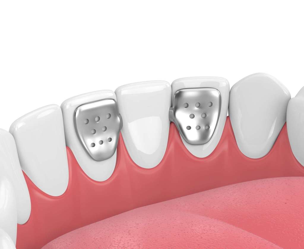 Dental Bridges London | Dental Care Centre